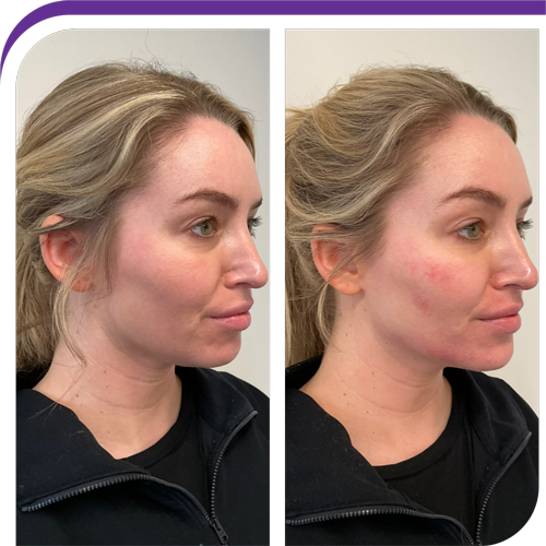 Dermal Fillers Sante Med Spa